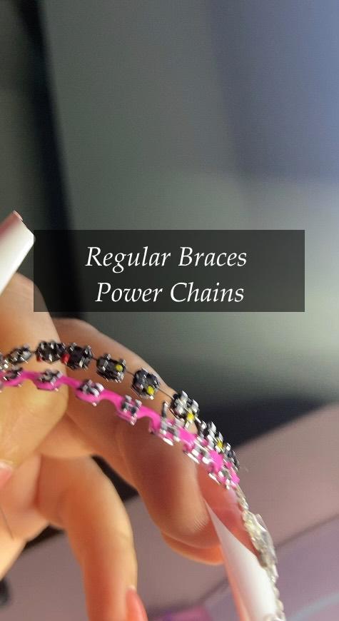 Braces & Braces Powerchains – kawaiibraces